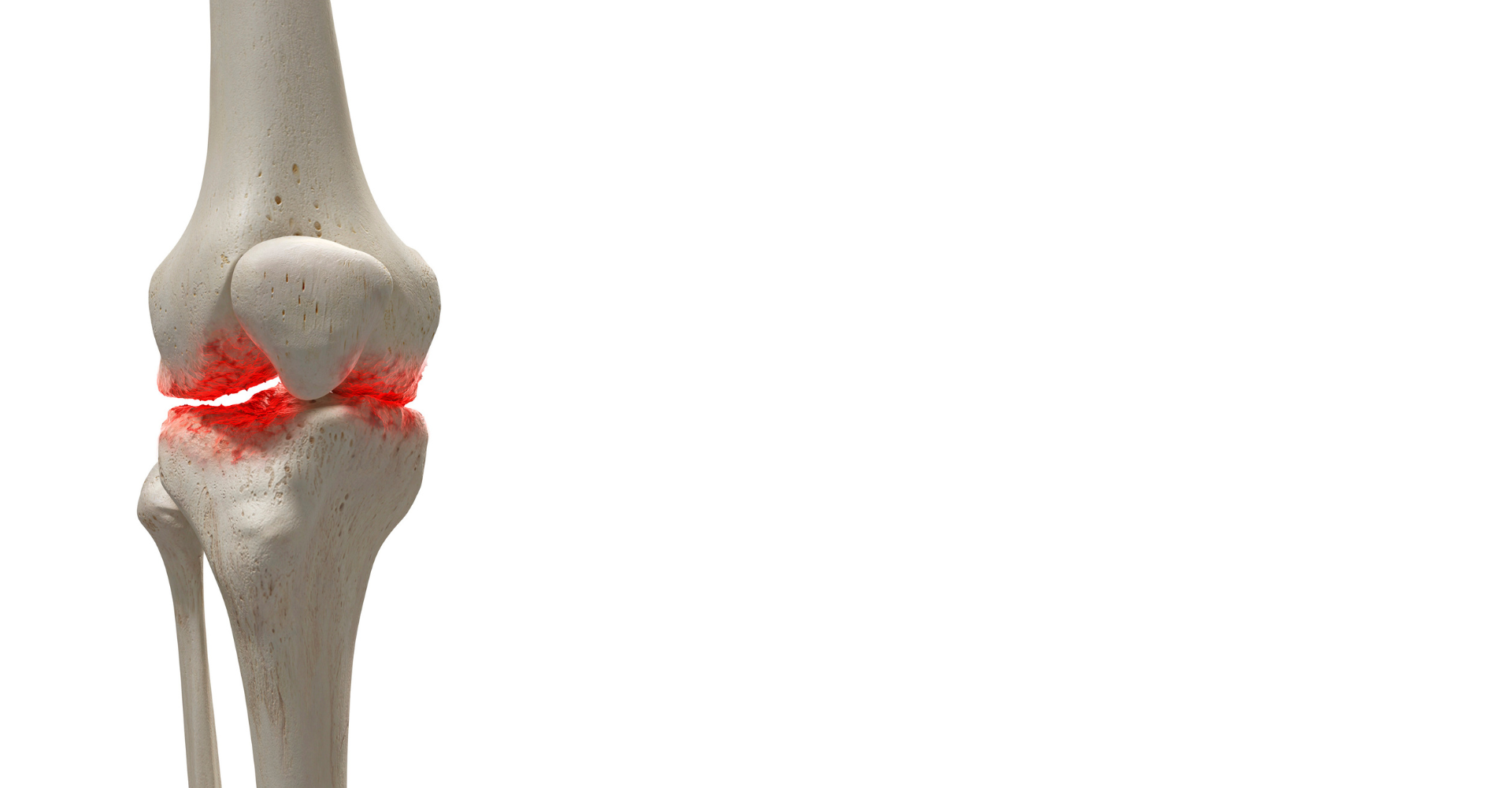 Arthrose du genou – Dr Lou Lequeuche